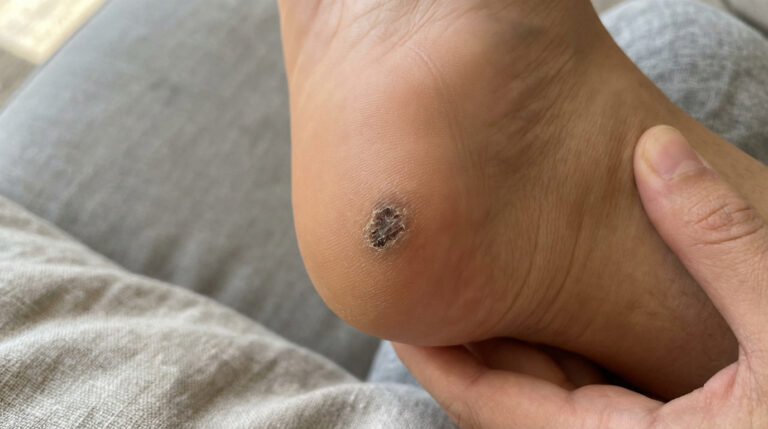 Kyste salivaire lèvre : causes et solutions du mucocèle